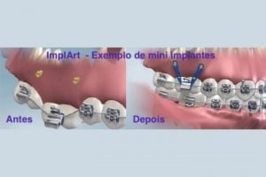 Novo mini implante dentário ortodôntico - Implantes menores