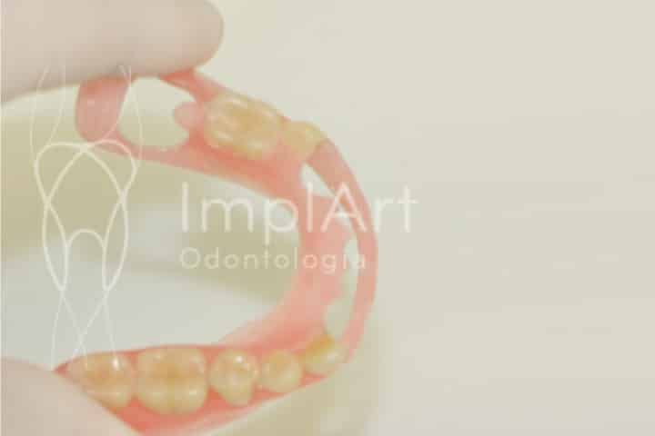 Prótese flexível: mais uma opção para os pacientes - ImplArt