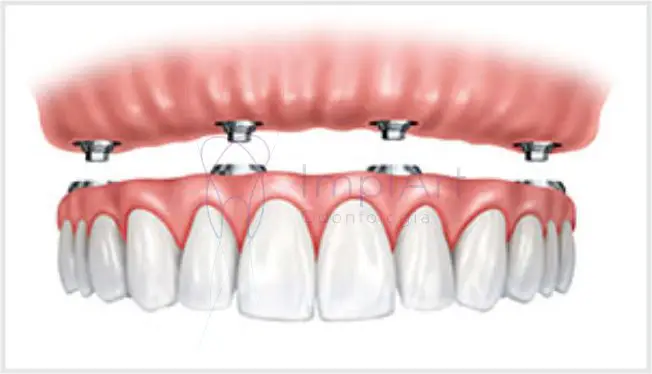 overdenture - ImplArt