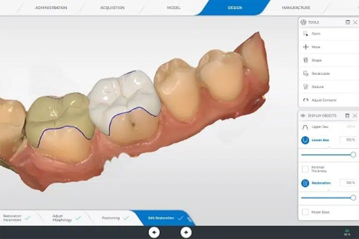 Cerec 3D - prótese digital automatizada em São Paulo - ImplArt Implantes