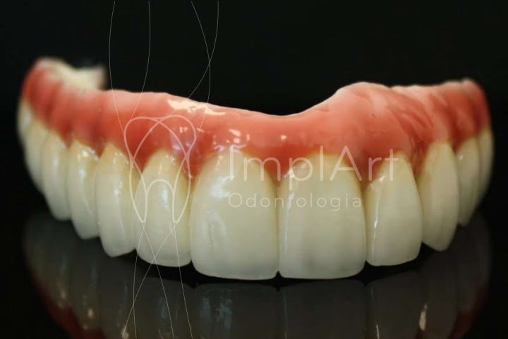 Fixed dental prosthesis - Specialist clinic - ImplArt