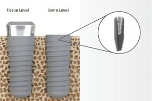 implante_bone_level_x_tissue_level_50kb - ImplArt