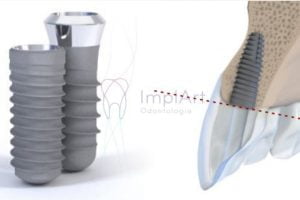 implante_de_nivel_osseo_bone_level_50kb - ImplArt