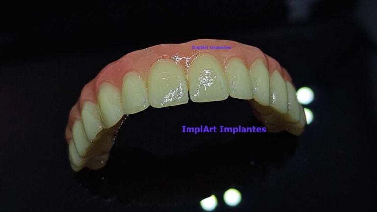 Prótese Protocolo Dentário: O que é, como é fixa no implante