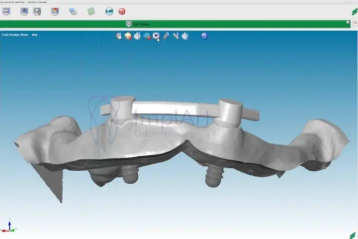 A prótese dental protocolo dentário com barra em titânio é mais leve