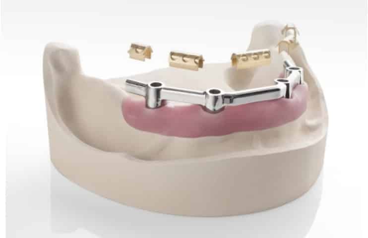 A prótese dental protocolo dentário com barra em titânio é mais leve