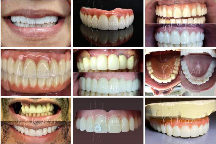 tipos de prótese dentarias - materiais de protese dentaria - ImplArt