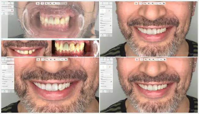 Dentes provisórios: como e porque são usados - ImplArt Implantes