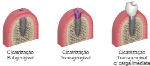 Bone_level - ImplArt