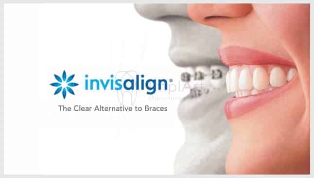 alinhadores_transparentes_invisalign_34kb - ImplArt