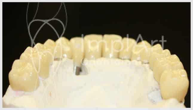 implante_total_dentes_individualizados_30kb - ImplArt