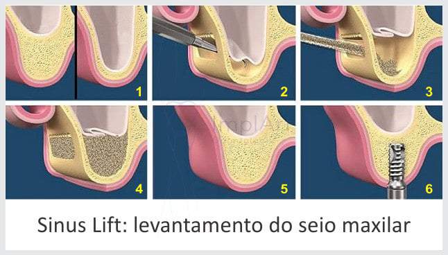 Enxerto ósseo levantamento do seio maxilar - sinus lift - ImplArt Implantes