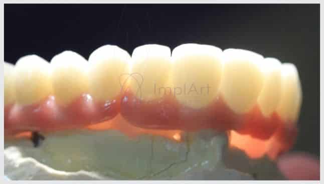 protocolo_branemark_1 - ImplArt