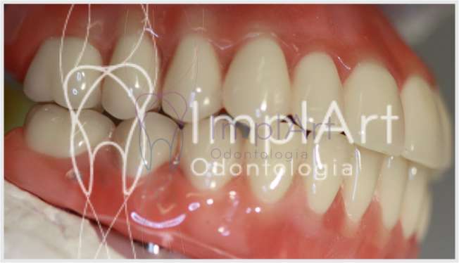 protese_protocolo_branemark_18kb - ImplArt