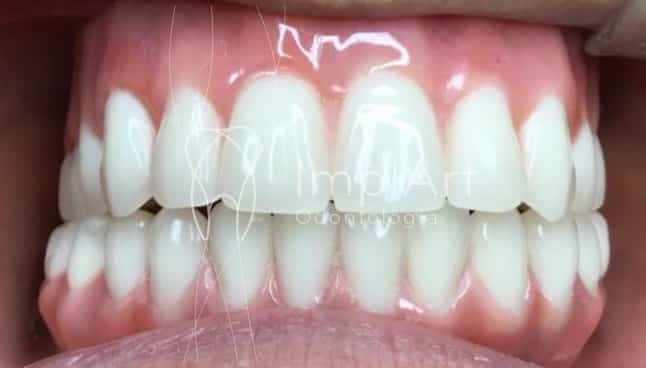 Prótese dentária protocolo fixa pode melhorar a autoestima