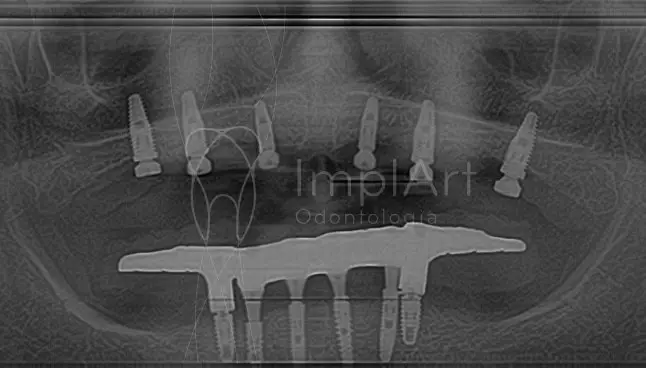 Prótese dentária protocolo fixa pode melhorar a sua autoestima - ImplArt