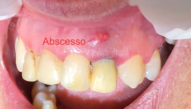 abscesso_dentário_49kb - ImplArt