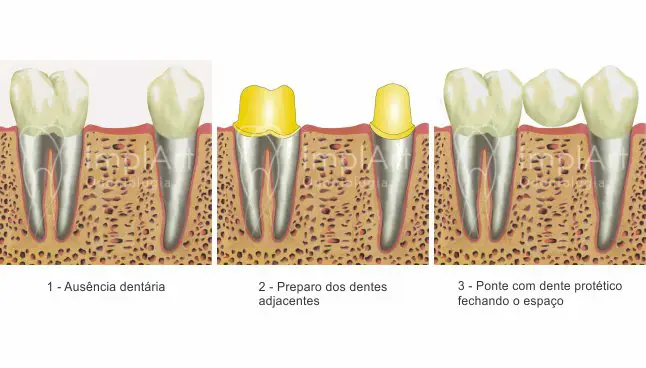 Alternativa ao implante dentário - Tipos de próteses - ImplArt Implantes