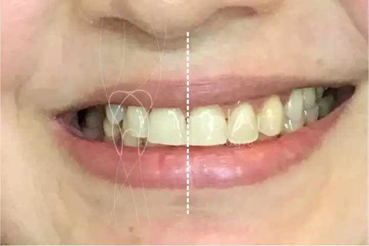 Assimetria do sorriso e da face tem tratamento - ImplArt Implante Estética