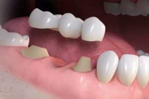 Ponte dentária fixa para completar o sorriso - ImplArt
