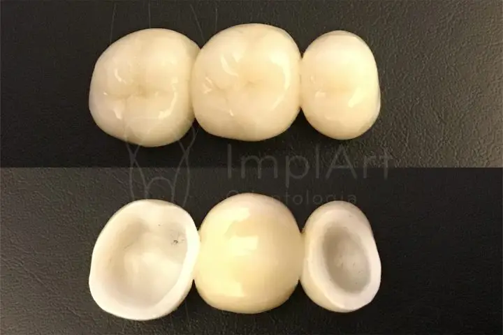 Ponte dentária fixa para completar o sorriso - ImplArt Implantes