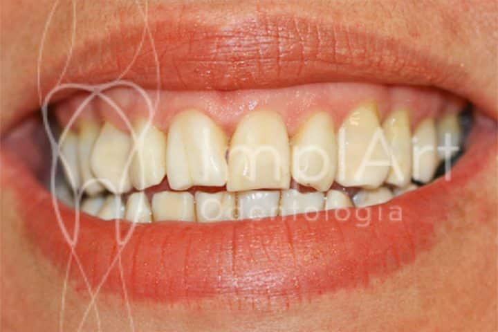 mancha_branca_dente_48kb - ImplArt