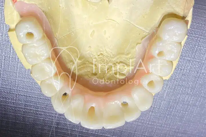 Prótese dentária fixa em zircônia translúcida 3D pura - O melhor ...