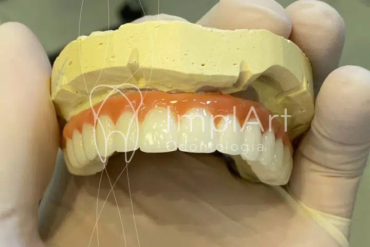 Protocolo em zircônia para maxilar superior completo implante dentário ...