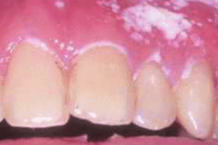 candidiase_oral_gengiva_50kb - ImplArt