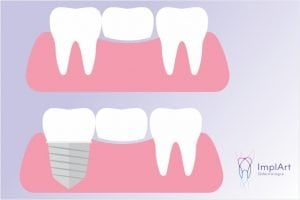 Ponte dentária fixa para completar o sorriso - ImplArt