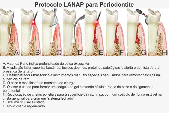 protocolo_lanap_periolase_periodontite_50kb - ImplArt