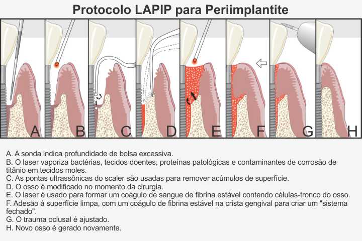 protocolo_lapip_periolase_periimplantite_50kb - ImplArt