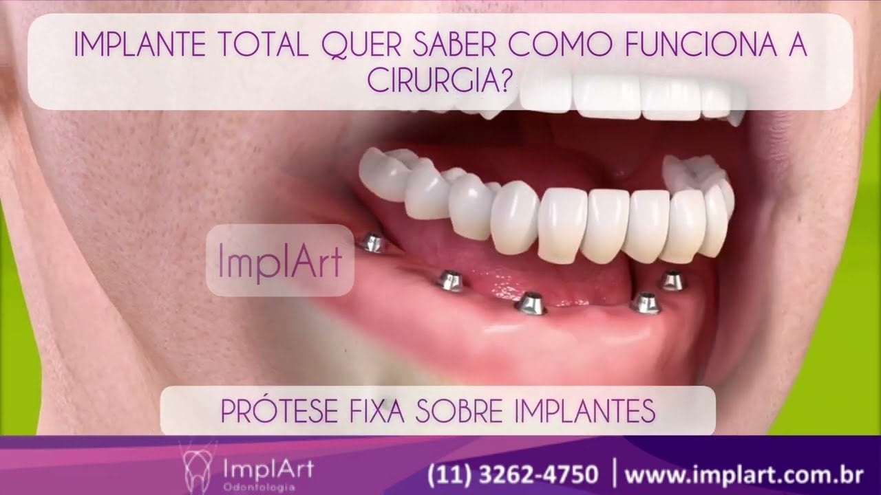 Miniatura do vídeo: IMPLANTE TOTAL - ARCADA COMPLETA ⭐Etapas de ...