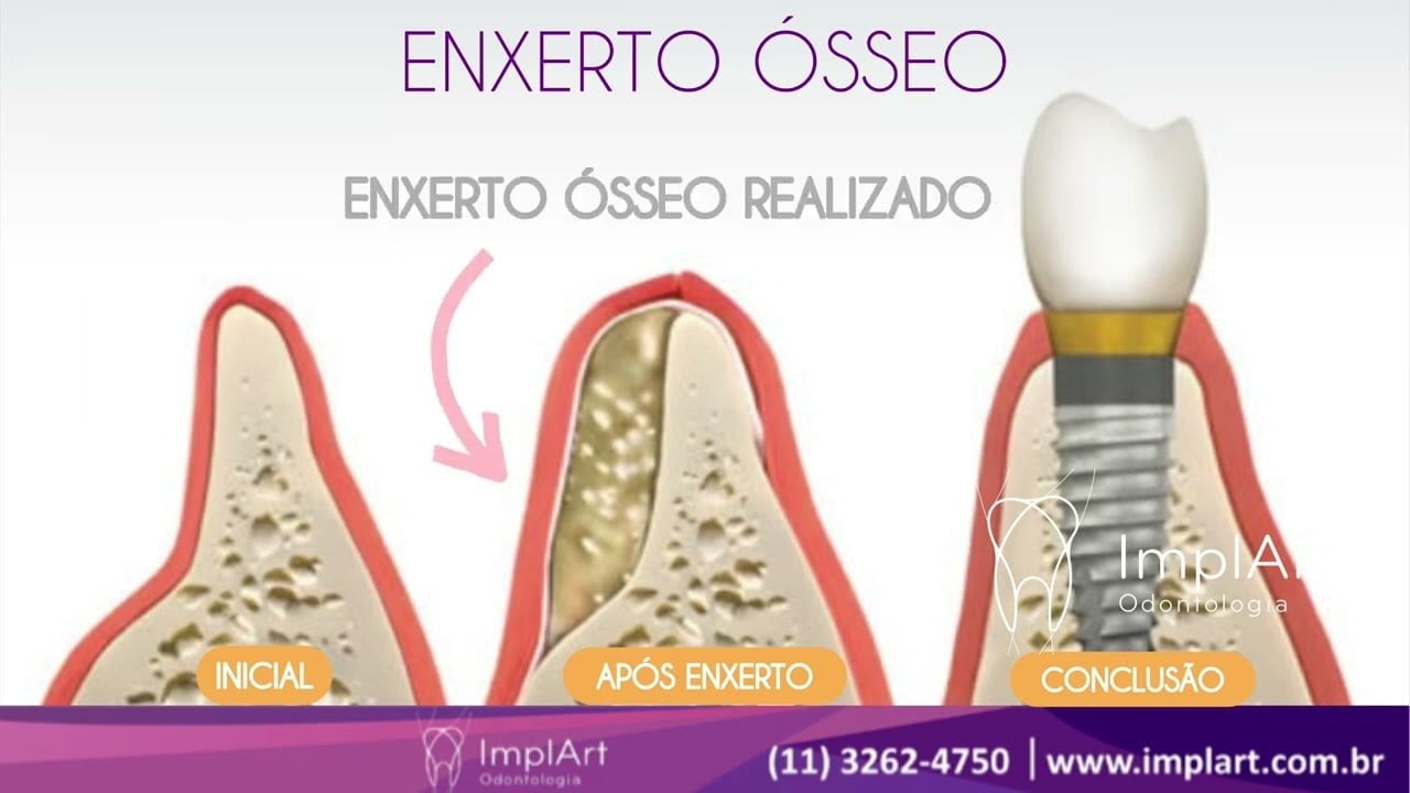 Miniatura do vídeo: ENXERTO ÓSSEO PARA IMPLANTE DENTARIO - SAIBA MAIS ...