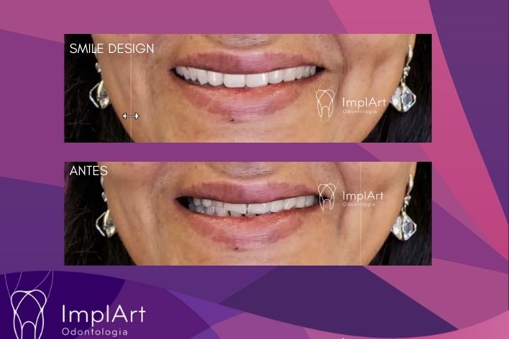 Smile Design 3D na Clínica ImplArt: Coroas, Lentes, Implante